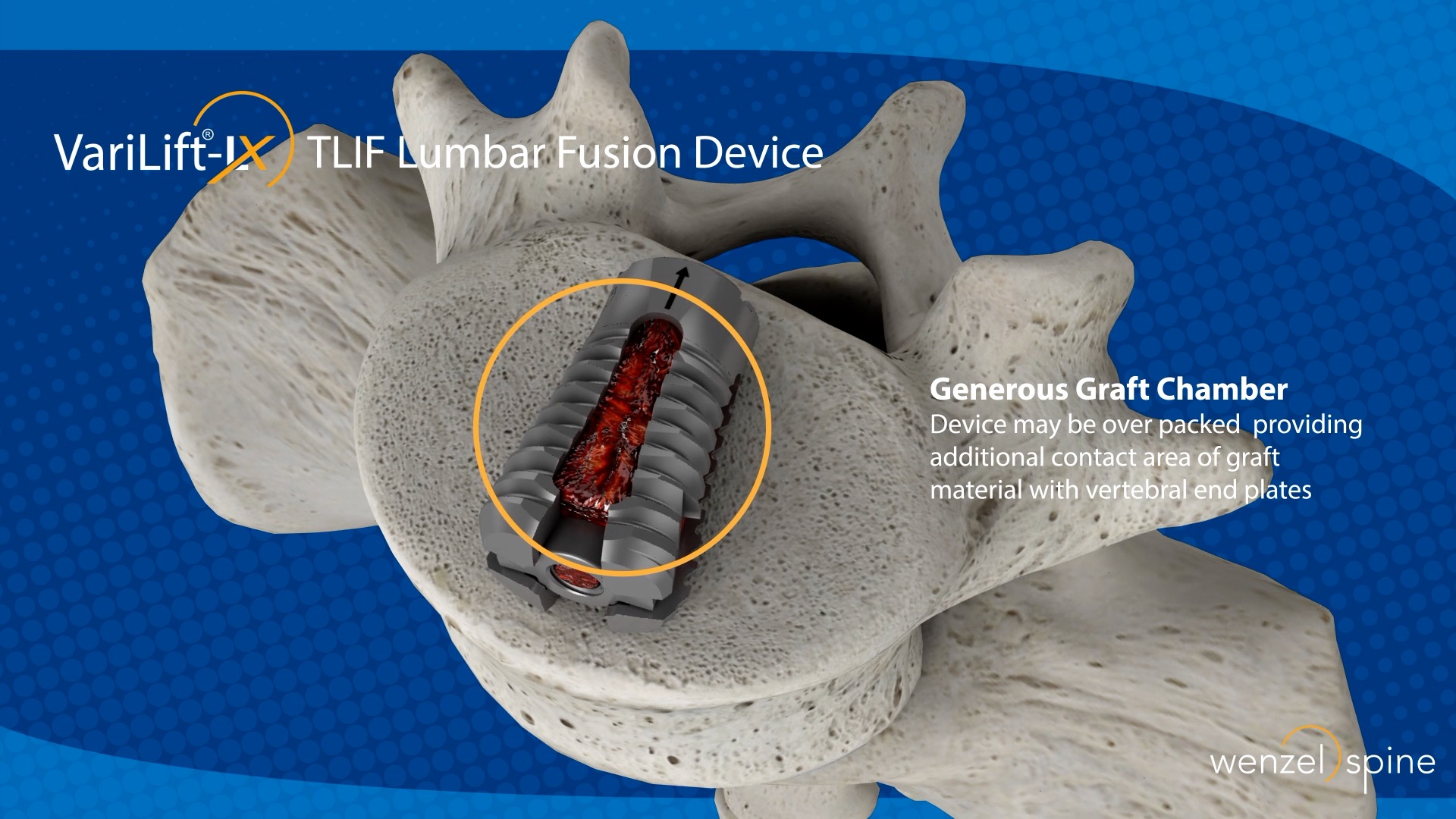 Wenzel Spine Announces FDA Clearance to Include Allograft with the ...