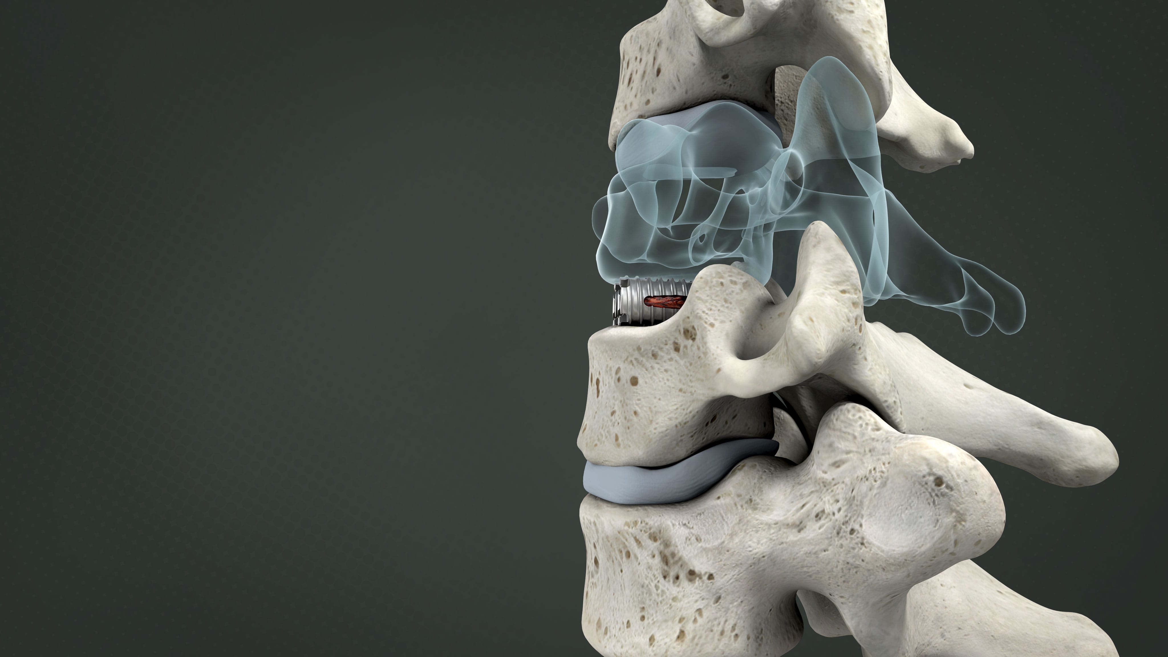 Andrew Fine, M.D. Finds “Ideal” Cervical Solution—VariLift®-C