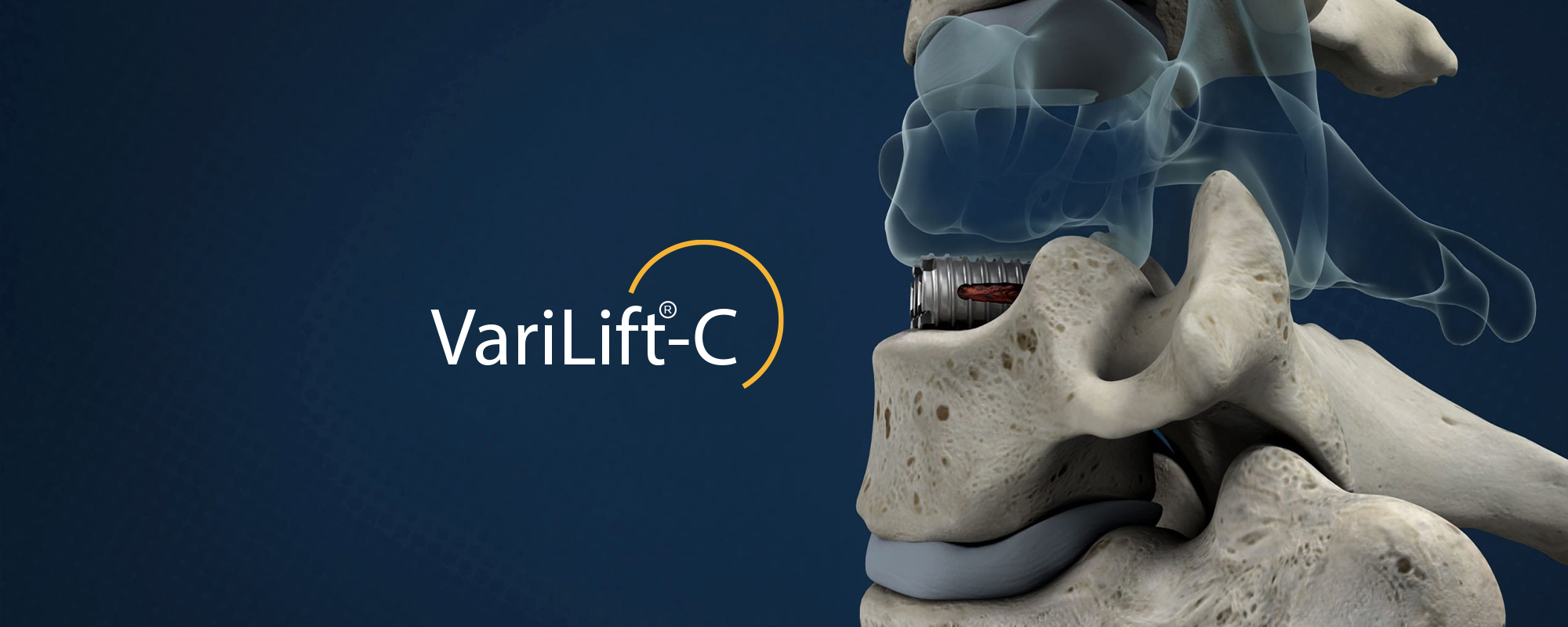 Wenzel Spine Announces Refinements and Extended Size Range of the ...